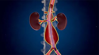 EVAR ASSIST 2 | GE HealthCare (Italy)